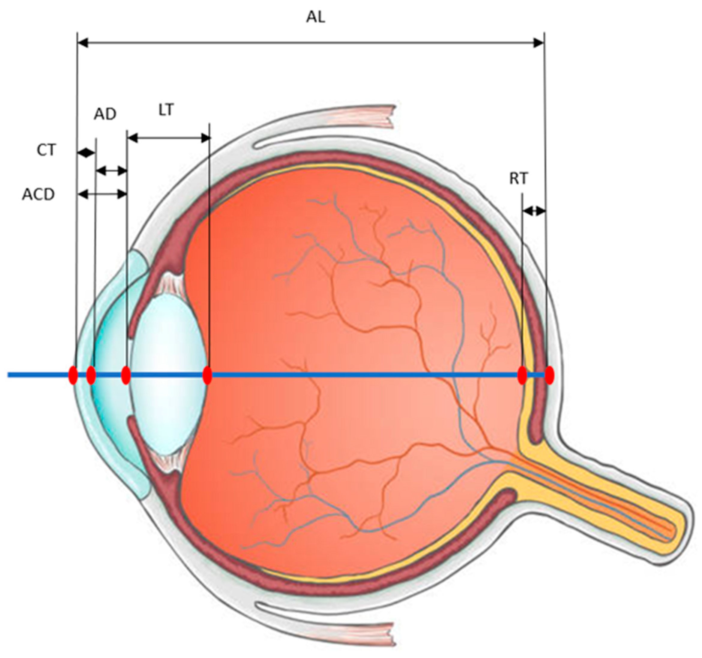 Variations in Lens Thickness Affecting the Anterior Chamber Length and ...