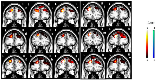 Portable Diffuse Optical Tomography for Three-Dimensional Functional ...