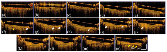 Discriminating Glioblastoma from Normal Brain Tissue In Vivo Using ...