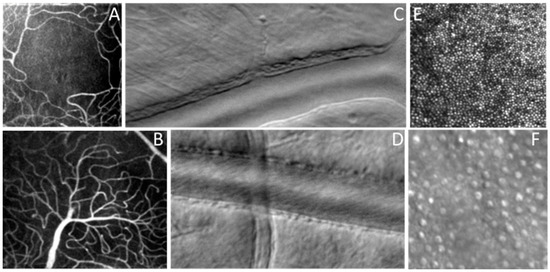 High-Resolution Retinal Imaging: Technology Overview and Applications