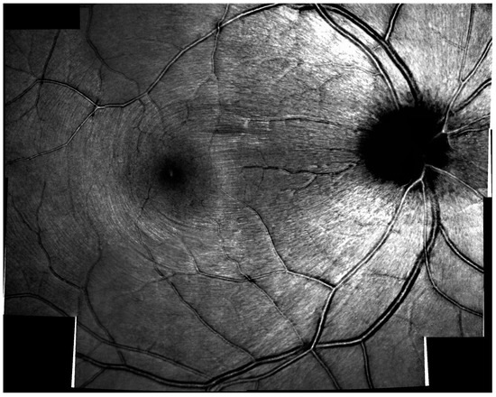 High-Resolution Retinal Imaging: Technology Overview and Applications