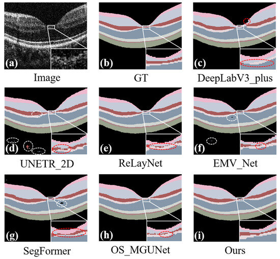 Mtnet A Multi Scale Framework Using The Transformer Block For Retina Layer Segmentation