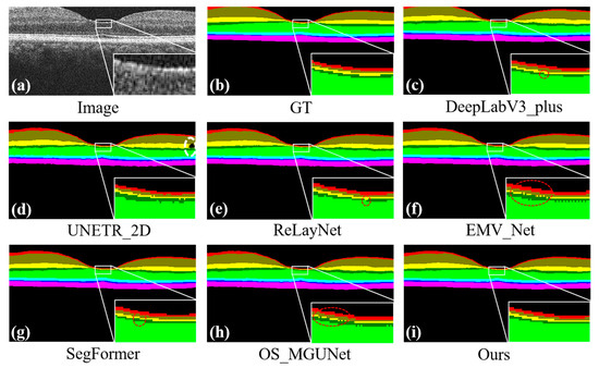 MT_Net: A Multi-Scale Framework Using the Transformer Block for Retina Layer Segmentation