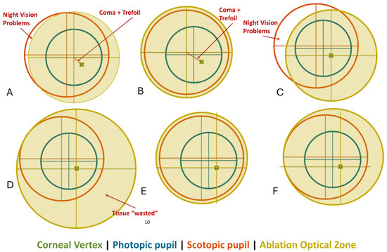 The Centration Dilemma in Refractive Corrections: Why Is It Still a ...