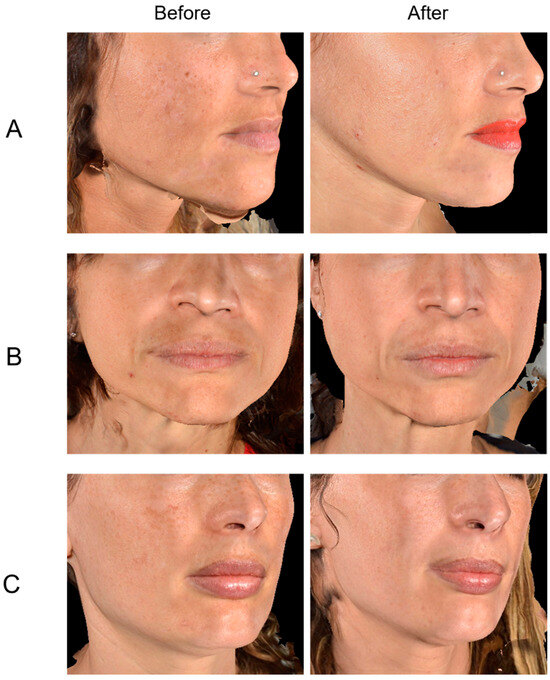Combined Efficacy of Q-Switched 785 nm Laser and Tranexamic Acid Cream ...
