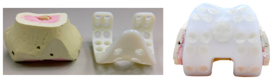 Polyethylene-Based Knee Spacer for Infection Control: Design Concept ...