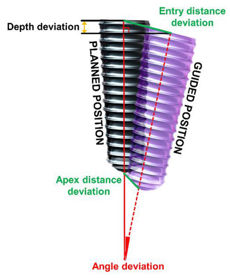 Effects of Groove Sealing of the Posterior Occlusal Surface and Offset ...