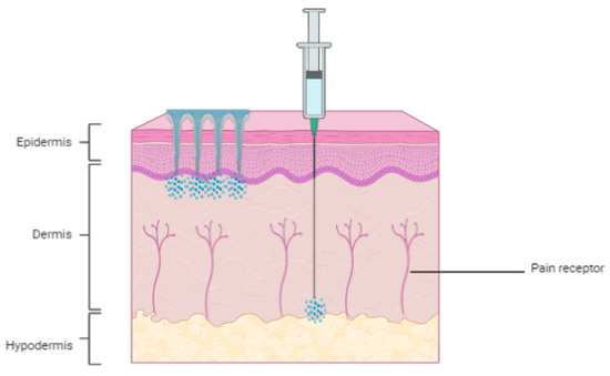 Recent Advances in Microneedle Platforms for Transdermal Drug Delivery ...