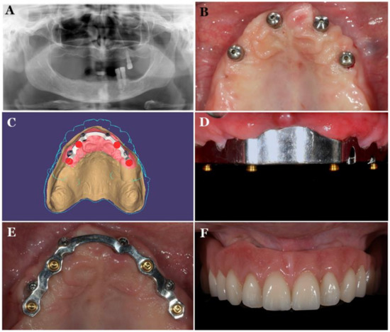 Biomechanical Aspects of Various Attachments for Implant Overdentures ...