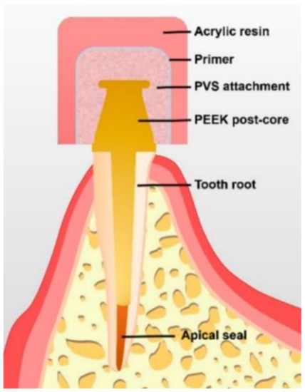 Biomechanical Aspects of Various Attachments for Implant Overdentures ...