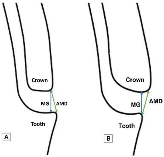 Effect of Finish Line Design on the Fit Accuracy of CAD/CAM Monolithic ...