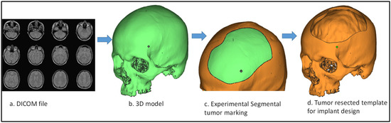Adaptive Mechanism for Designing a Personalized Cranial Implant and Its ...