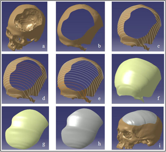 Adaptive Mechanism for Designing a Personalized Cranial Implant and Its ...