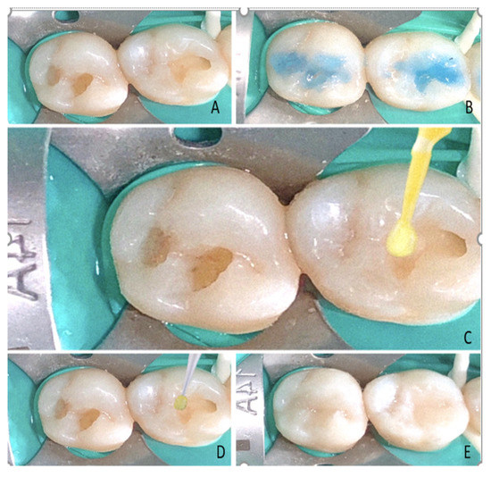 Efficacy of Three Commercially Available Desensitizers in Reducing Post ...