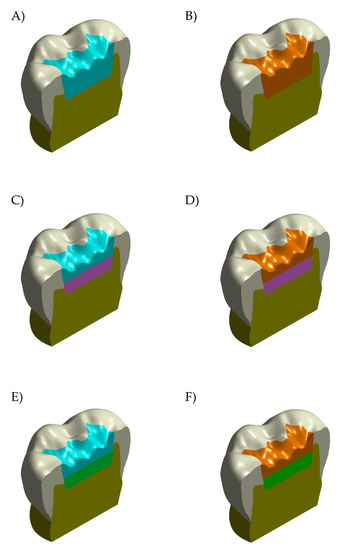 Polymers | Free Full-Text | Mechanical Behavior of Alkasite Posterior ...