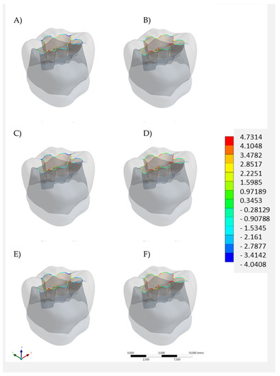 Polymers | Free Full-Text | Mechanical Behavior of Alkasite Posterior ...