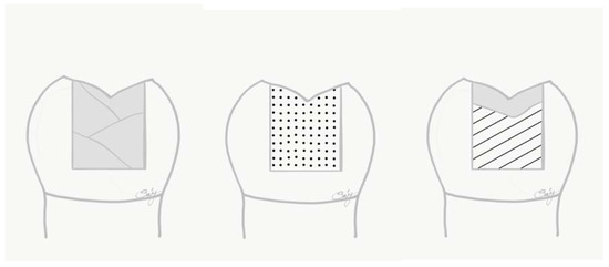 Polymers | Free Full-Text | Fracture Resistance and Microleakage around ...