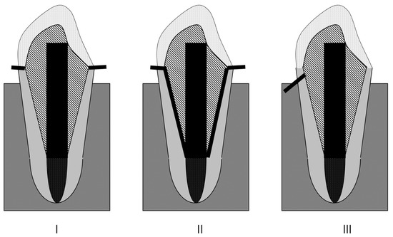 Influence of New Sleeve Composite on Fracture Behavior of Anterior ...
