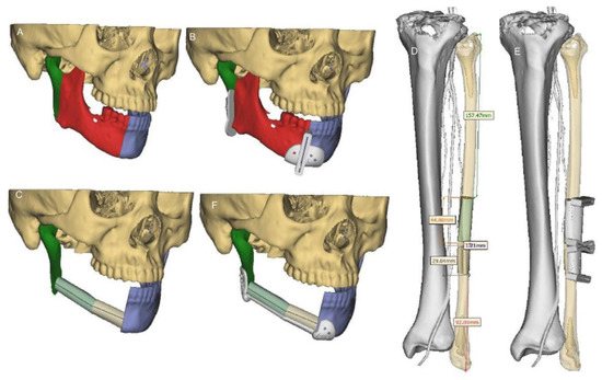 Hydrogel: A Potential Material for Bone Tissue Engineering Repairing ...