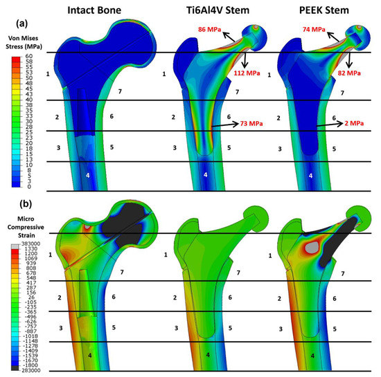 Polymers | Free Full-Text | Stress Shielding and Bone Resorption of ...