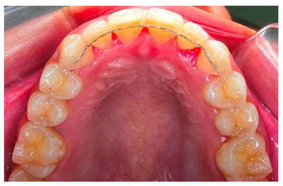 The Use of Polymers to Enhance Post-Orthodontic Tooth Stability