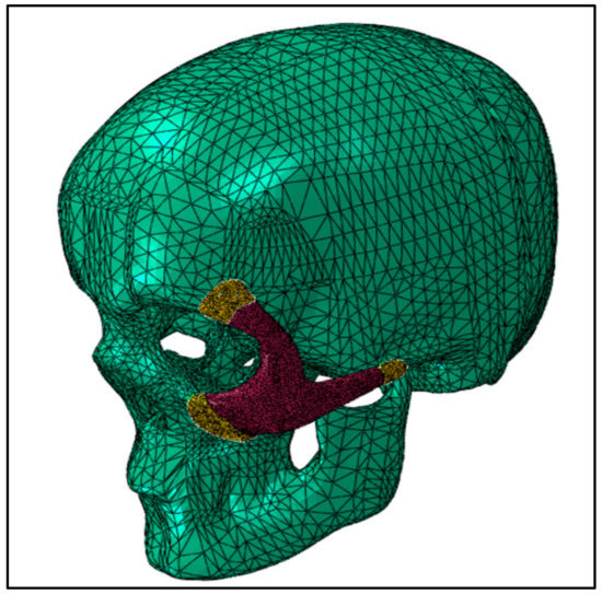 Polymers | Free Full-Text | Design, Analysis, and 3D Printing of a Patient-Specific ...