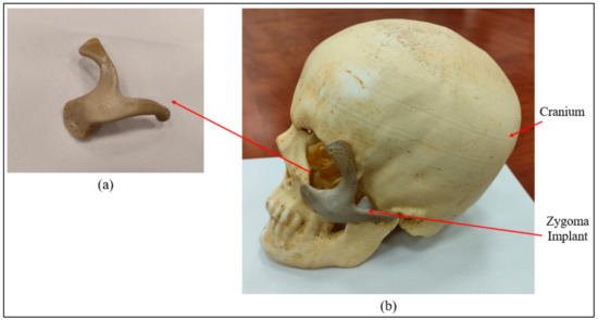 Design, Analysis, and 3D Printing of a Patient-Specific ...