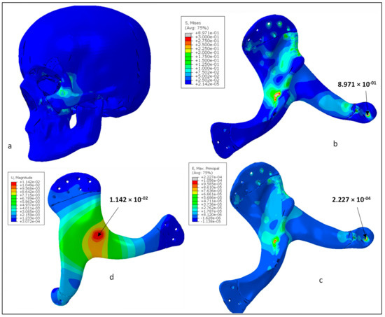 Polymers | Free Full-Text | Design, Analysis, and 3D Printing of a Patient-Specific ...