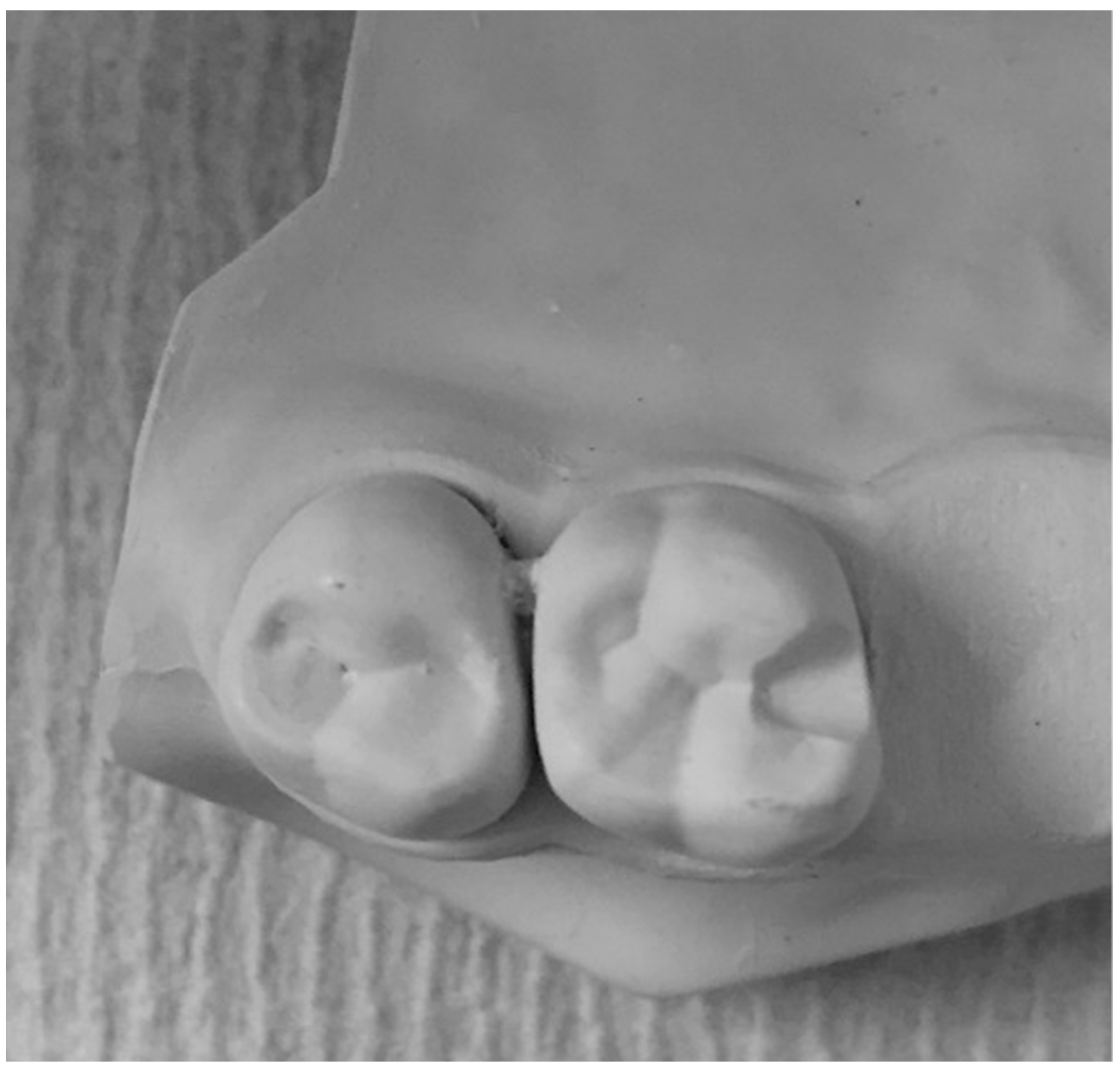 Retentive Forces and Deformation of Fitting Surface in RPD Clasp Made ...