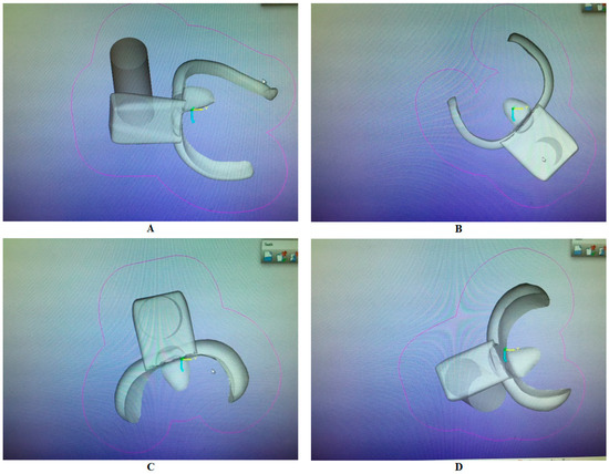 Retentive Forces and Deformation of Fitting Surface in RPD Clasp Made ...