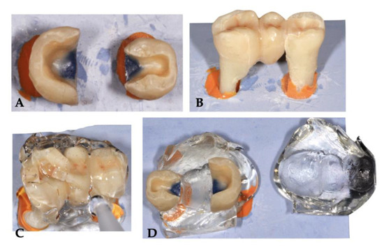 Fatigue Resistance of Dissected Lower First Molars Restored with Direct ...