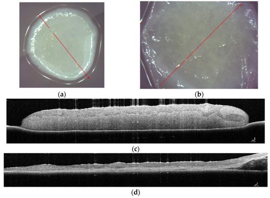 Polycaprolactone Electrospun Nanofiber Membrane with Skin Graft ...