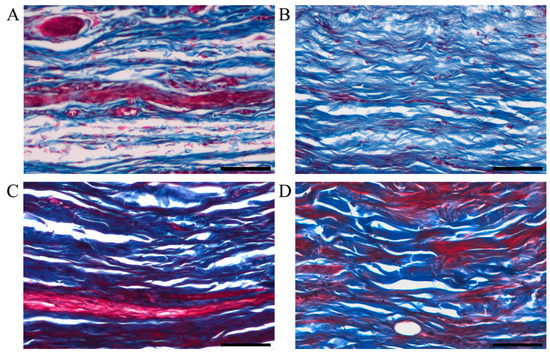 Soluble Polymer Microneedles Loaded with Interferon Alpha 1b for ...