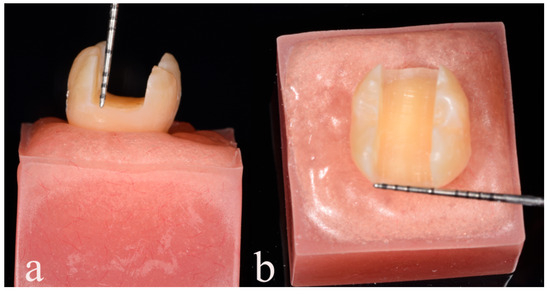 Fracture Resistance of Class II MOD Cavities Restored by Direct and ...