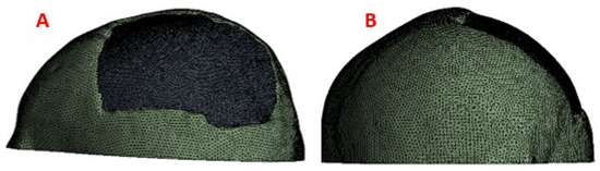 Finite Element Analysis of Patient-Specific 3D-Printed Cranial Implant ...