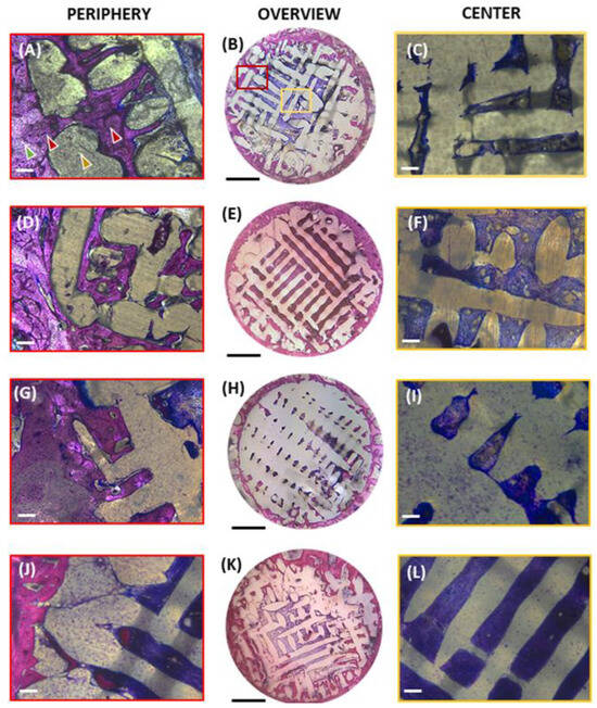 Poly-ε-Caprolactone 3D-Printed Porous Scaffold in a Femoral Condyle ...