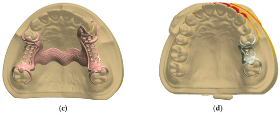 Suitability and Trueness of the Removable Partial Denture Framework ...