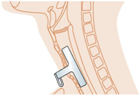 Plasma Surface Modification of the Inner Wall of Montgomery’s Tracheal ...