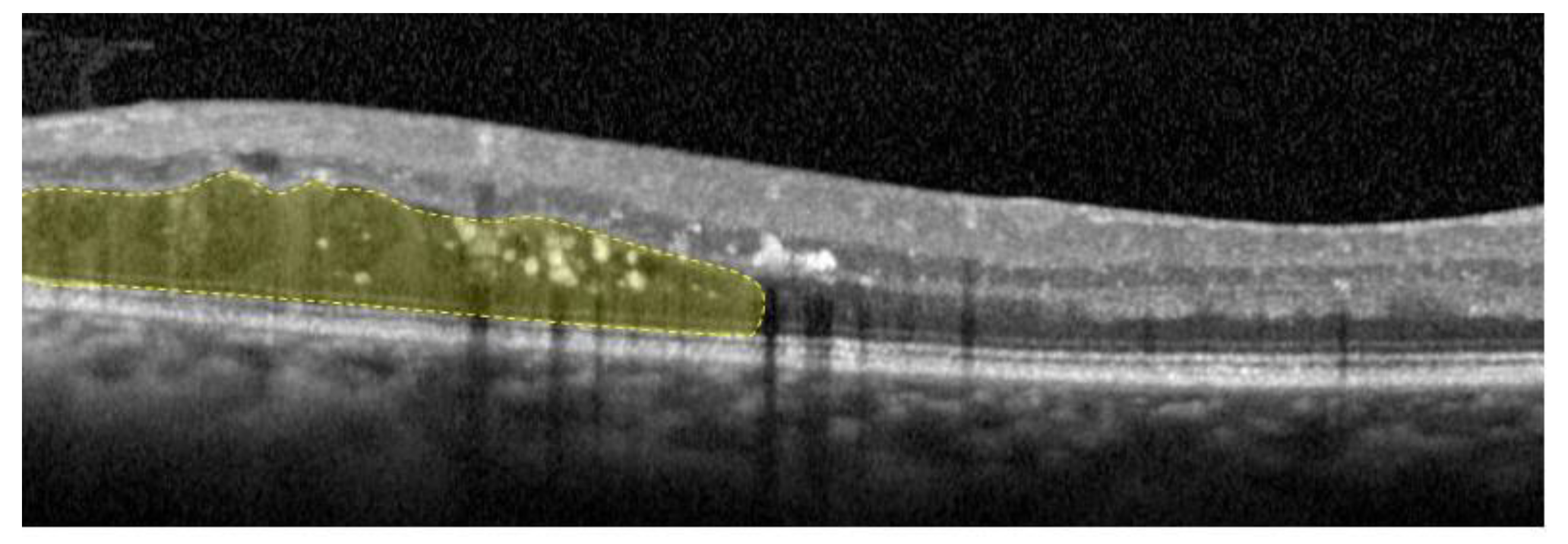 Automatic Identification and Segmentation of Diffuse Retinal Thickening Macular Edemas Using OCT ...