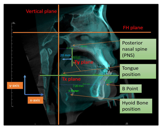 Computational Fluid Dynamic Analysis of the Pharyngeal Airway after ...