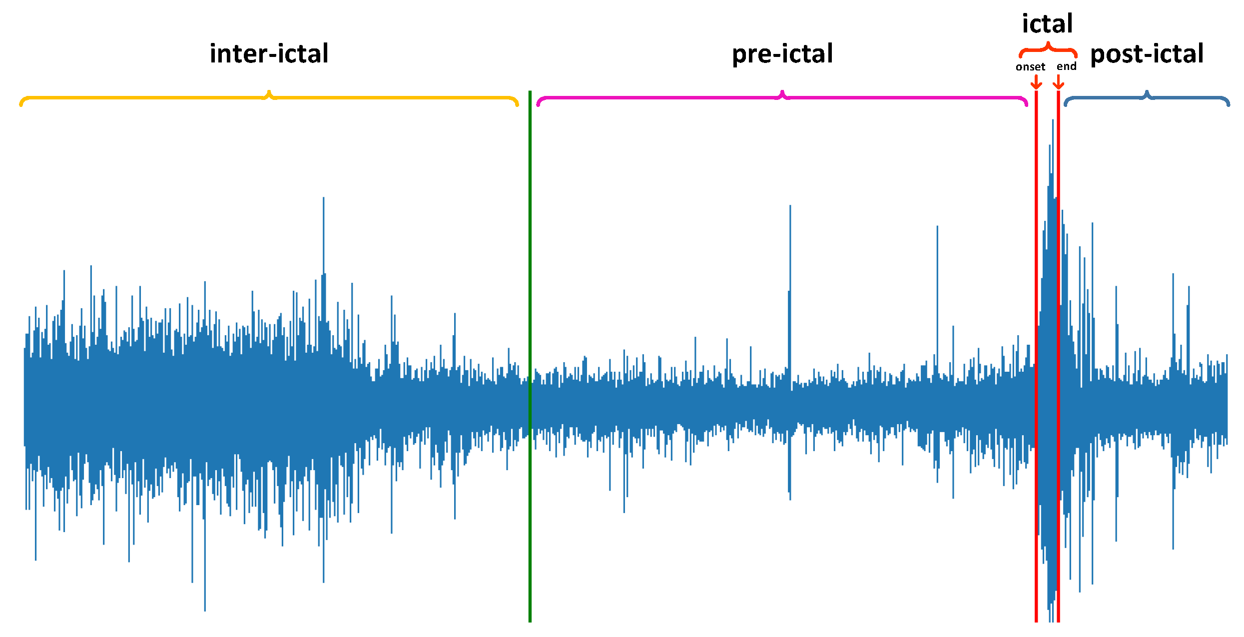 Epilepsy Seizure Eeg