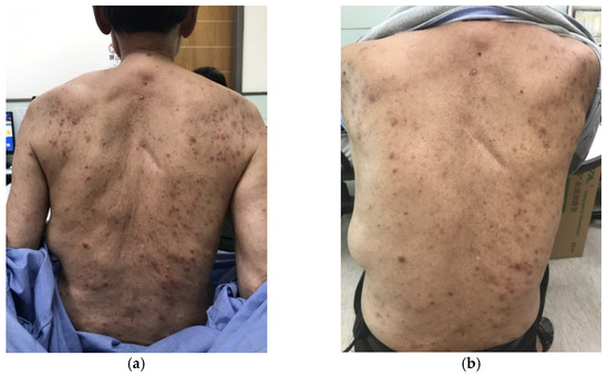 Efficacy and Safety of Modified Huang-Lian-Jie-Du Decoction Cream on ...