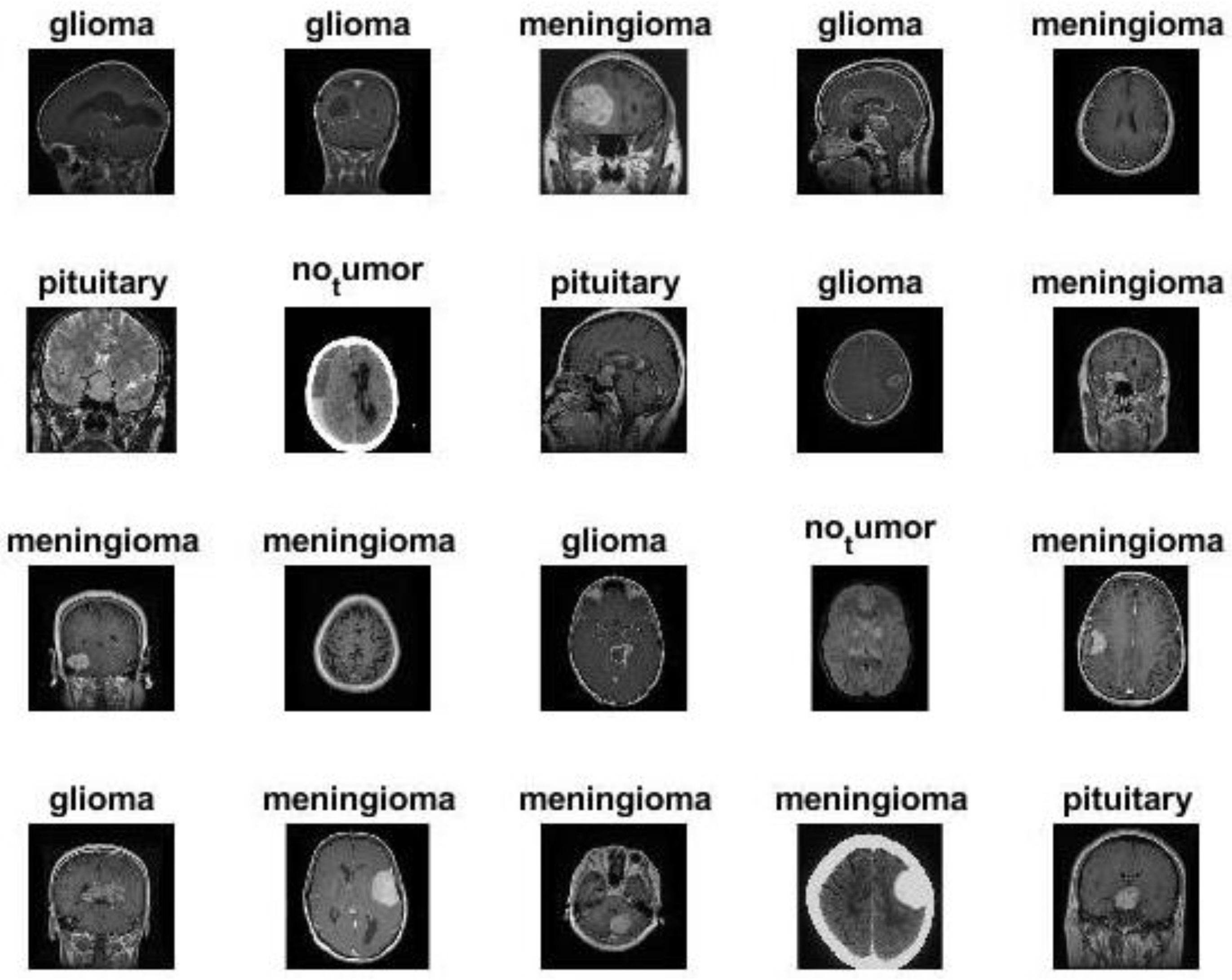 Hybrid Techniques of Analyzing MRI Images for Early Diagnosis of Brain ...
