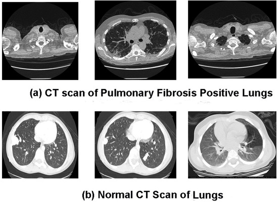 Deep Transfer Learning Techniques-Based Automated Classification and Detection of Pulmonary ...