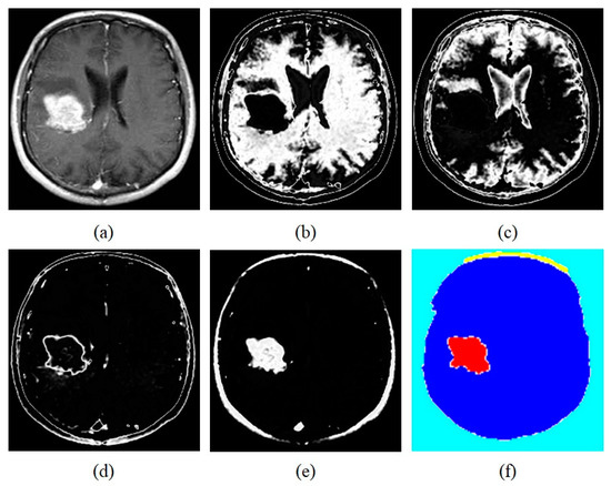 Processes | Free Full-Text | Classification of Tumor in Brain MR Images ...