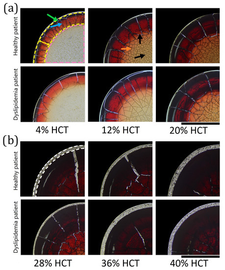 Dried Droplets of Diluted Blood to Detect a High Concentration of Lipids