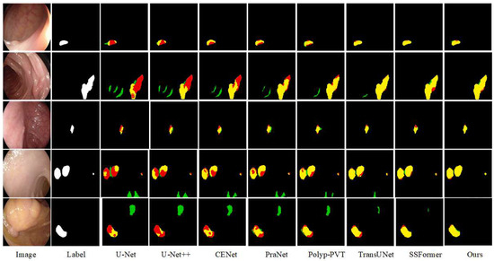 Improving Polyp Segmentation with Boundary-Assisted Guidance and Cross ...