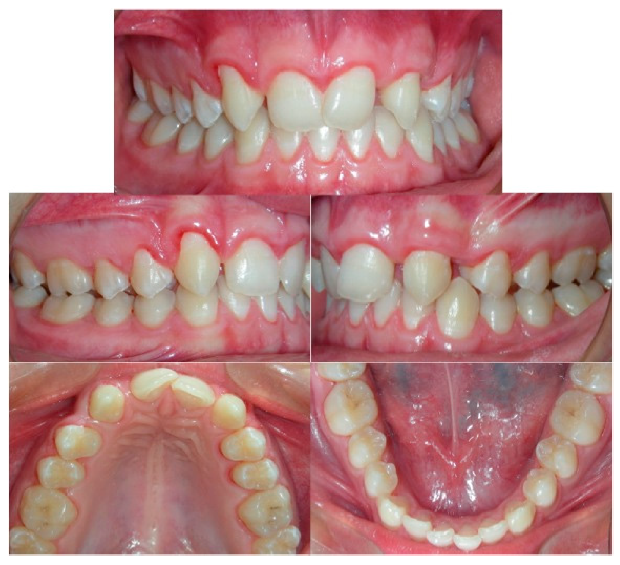 An Integrated Approach, Orthodontic and Prosthetic, in a Case of ...