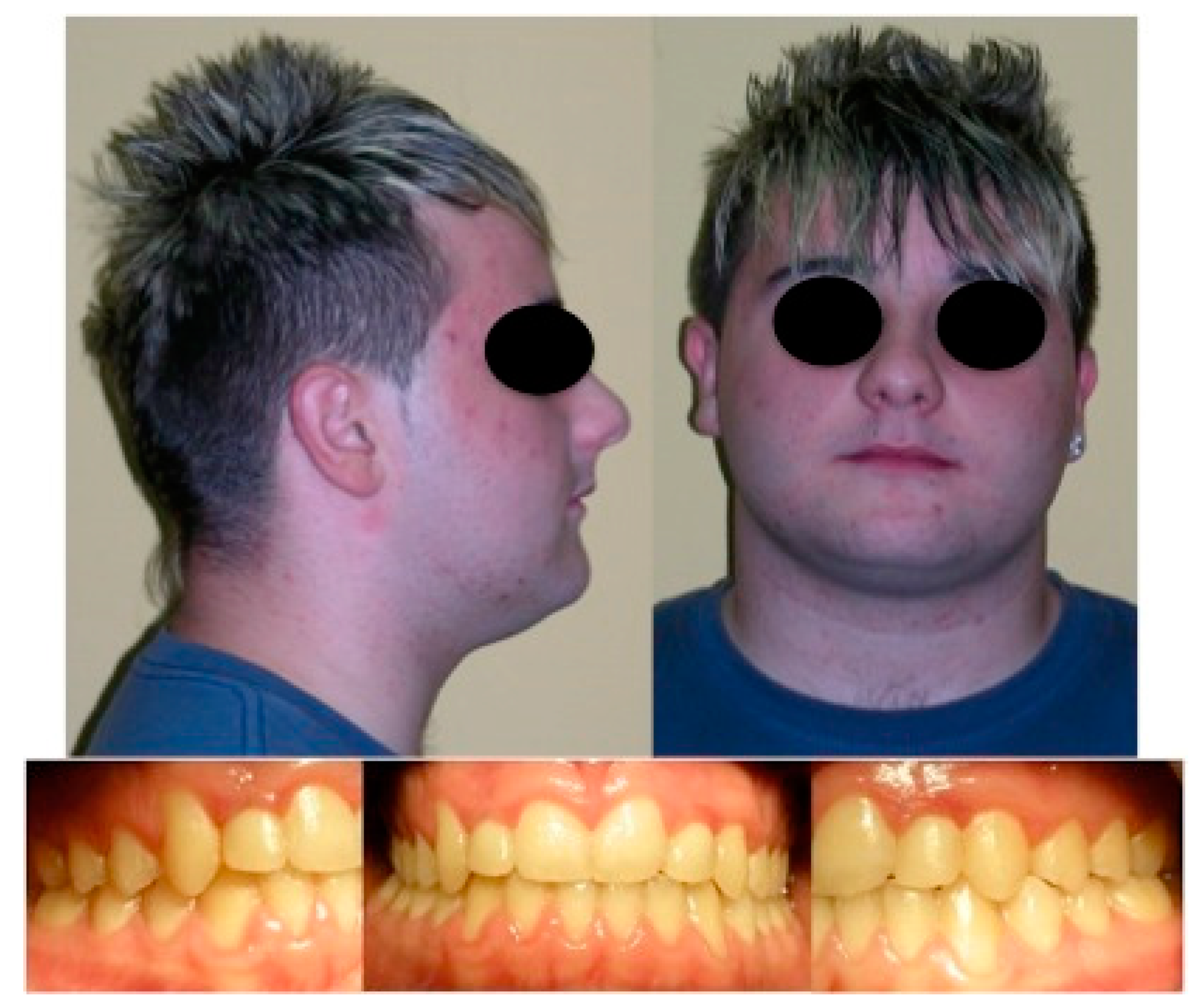 An Integrated Approach, Orthodontic and Prosthetic, in a Case of ...