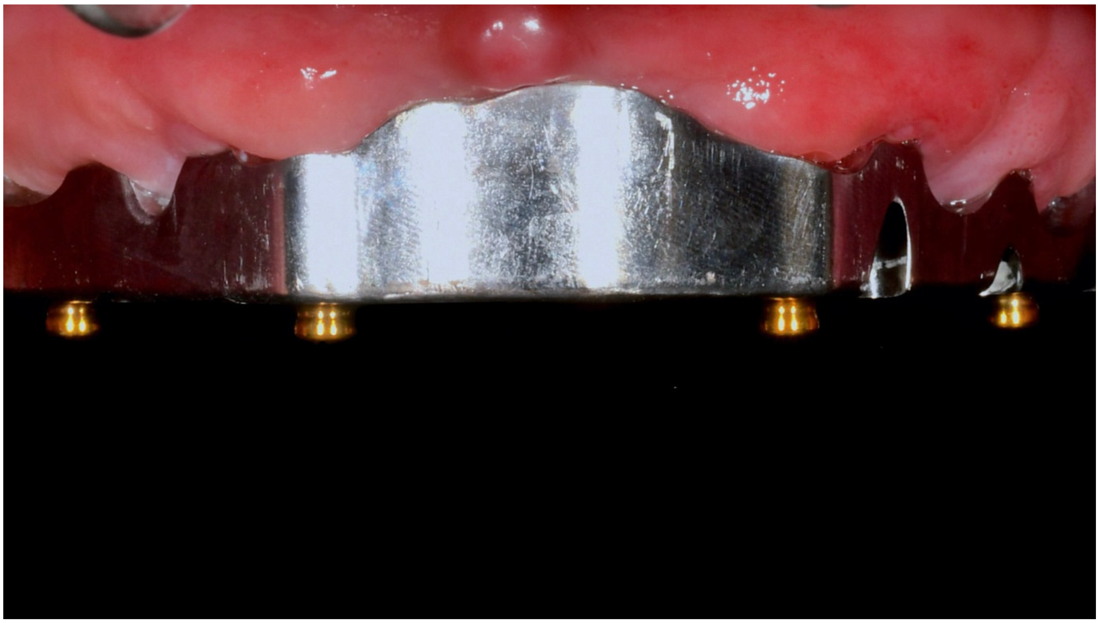 Minimally Invasive Treatment of Edentulous Maxillae with Overdenture ...